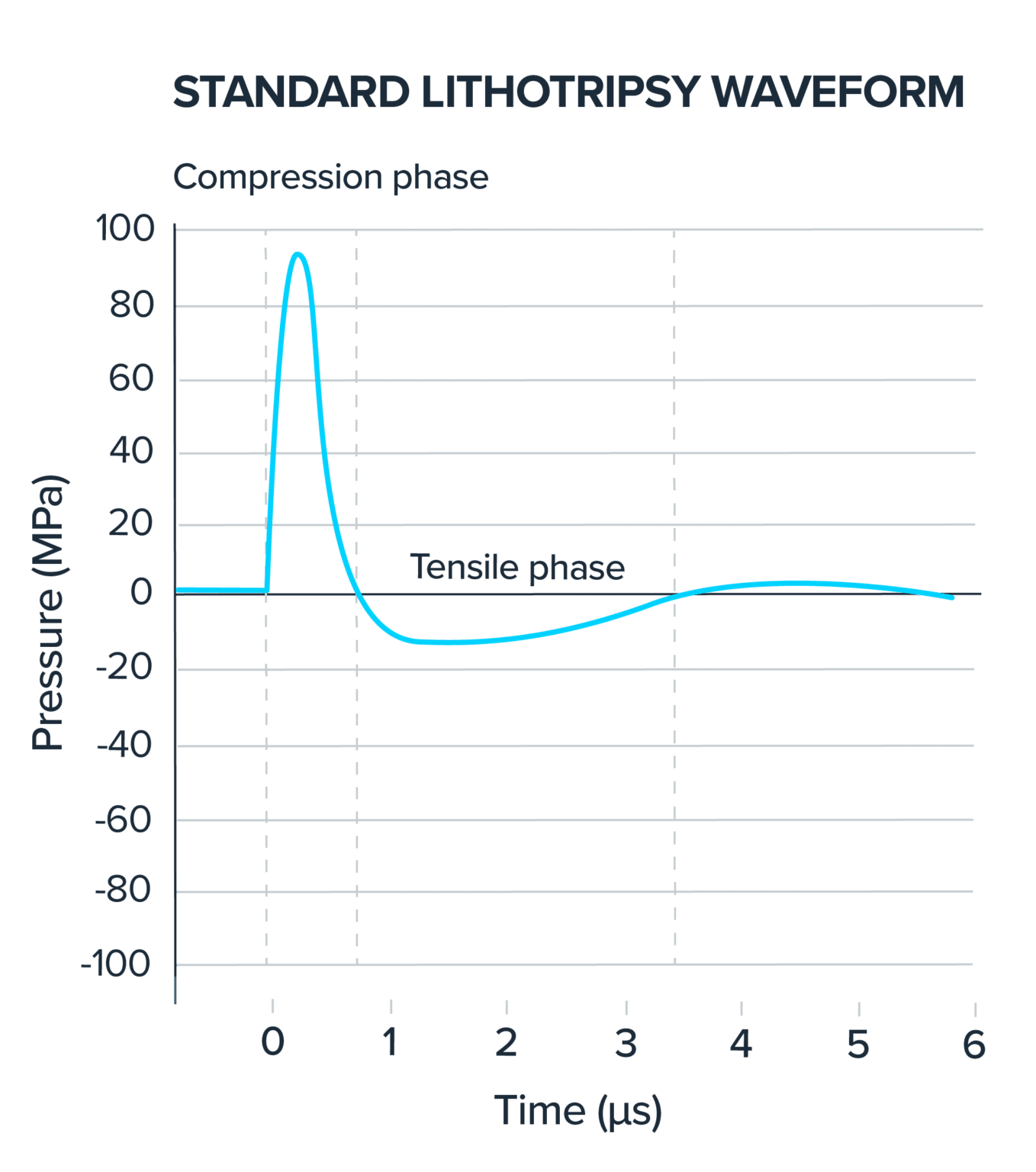 IVL Overview And MOA - Shockwave Medical