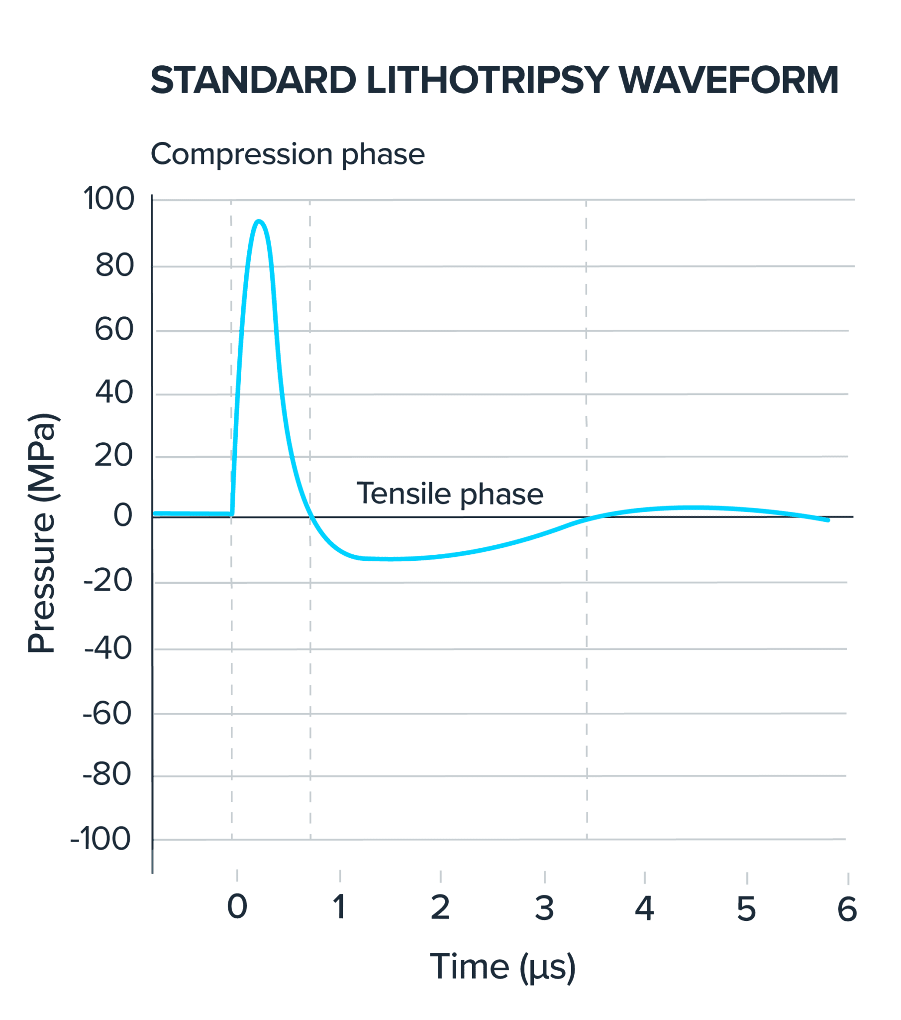 IVL Overview And MOA - Shockwave Medical