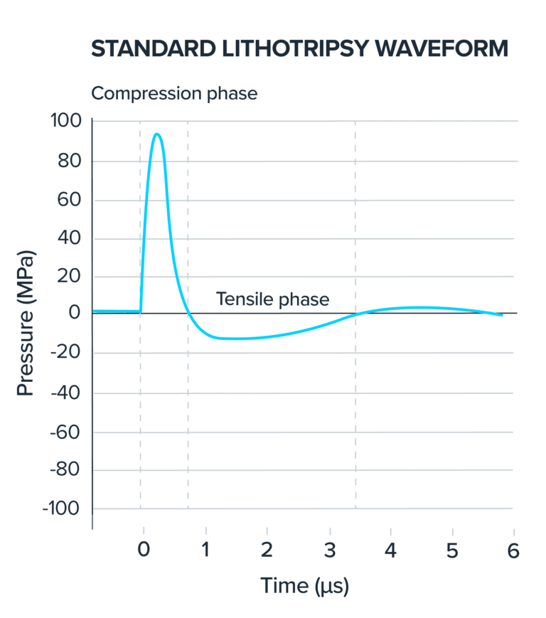IVL Overview And MOA - Shockwave Medical