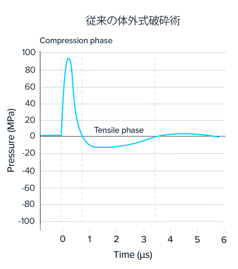 IVL Overview And MOA - Shockwave Medical
