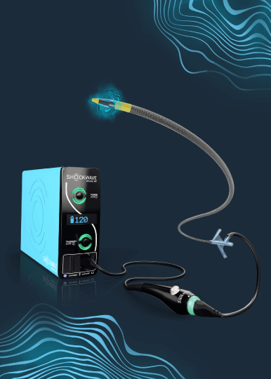 Introducing Shockwave Javelin For Calcified Occlusive Disease: A ...