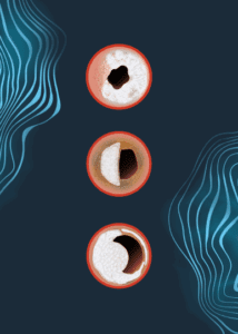 Shockwave Javelin: Severe TPT Stenosis, AT & PT Occlusion Case Review ...